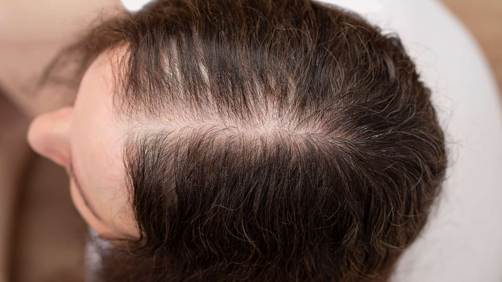 Understanding Thinning Hair in Women: Causes and Solutions - The Queen Zone
