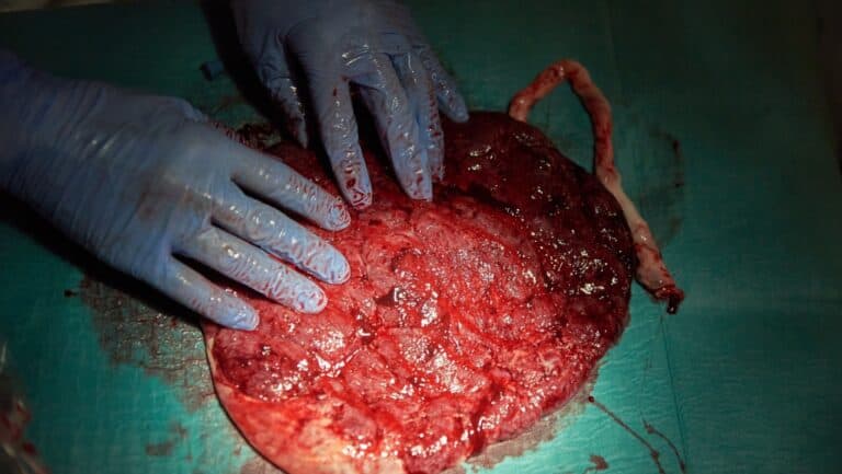 Placental Analysis: The Game-Changing Practice That Could Improve ...