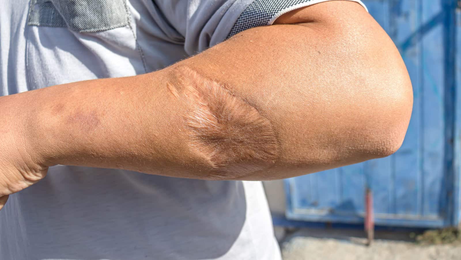 Rabies Risk: How to Respond if Bitten by a Dog with Unknown Vaccination ...
